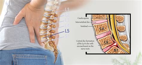 Herniated Disc L4 L5