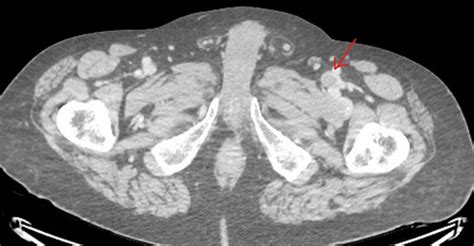 DVT On CT Vascular Medicine Angiologist