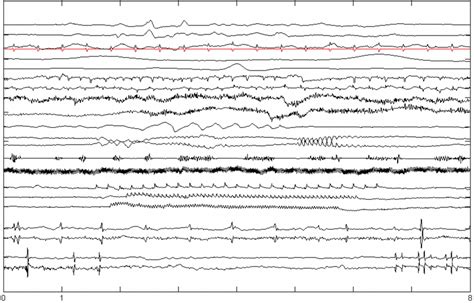 Common Eeg Artifacts Found In The Eeg Database Photic Stimuli Should Download Scientific Common Eeg Artifacts Found In The Eeg Database Photic Stimuli Should Download Scientific