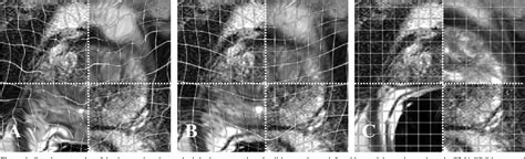 Figure 1 From Validation Of Deformable Registration Of Prostate Mri With And Without Endorectal