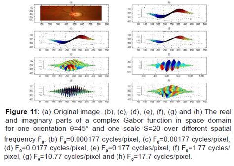 Applying A Set Of Gabor Filter To 2d Retinal Fundus Image To Det