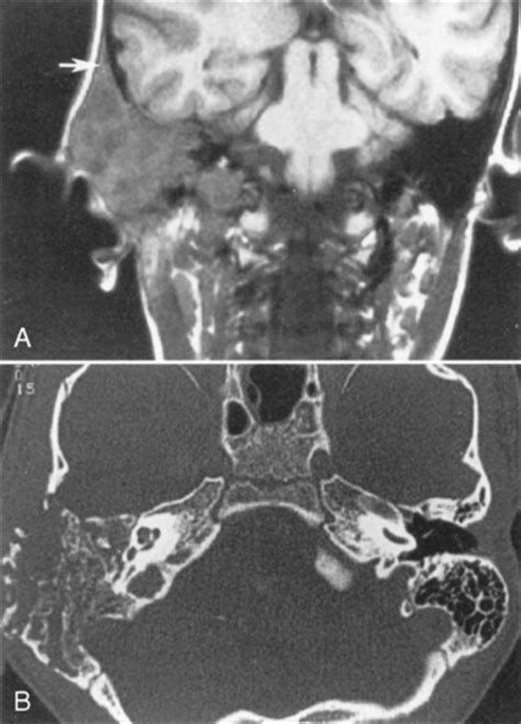 Temporal Bone Neupsy Key