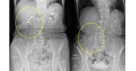 長期腰痠腰痛，不一定都是骨刺，竟是「這1器官」離家出走造成！ 蕃新聞