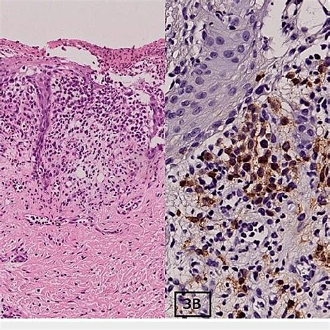 Ulcerative Lesions In Labia Majora Labia Minora And Perineal Region Download Scientific
