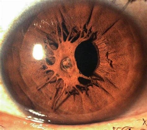 An Iris Growing Over A Pupil Creepy Genetics Iris Pupil