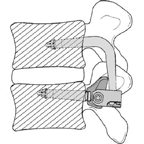 Pdf Effect Of The Total Facet Arthroplasty System After Complete