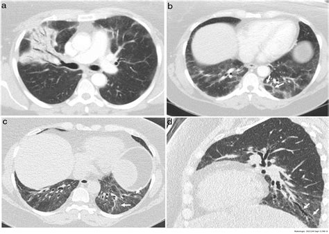 Organizing Pneumonia Radiología English Edition
