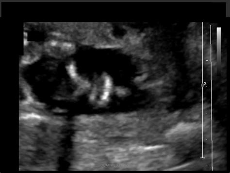 5 Fetal Face Ultrasound Dr Ahmed Esawy Pdf