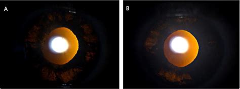 Iris Transillumination A Right Eye B Left Eye Download Scientific Diagram