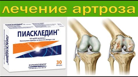 Лекарство для лечения артроза коленного сустава Youtube