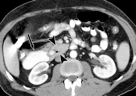 Annular Pancreas Ultrasound
