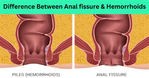 Anal Fissure Vs Hemorrhoids 3 Main Symptoms To Differentiate Easily