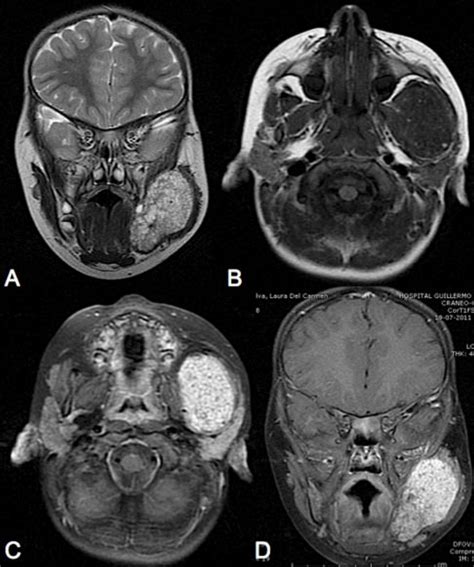 a t2 sequence showing a hyperintense area of the lesion b t1