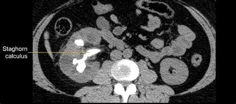 Xanthogranulomatous Pyelonephritis Ct