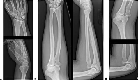 Figure 1 From Simultaneous Dislocation Of The Radiocapitellar And Distal Radioulnar Joints