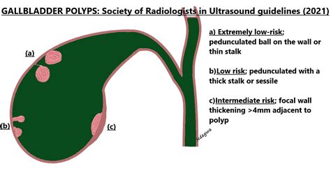 Sru Guidelines On Gallbladder Polyps David Ndegwa Posted On The Topic