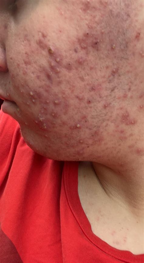 Acne Vulgaris — «Պրոֆ Հ Ա Քալամքարյանի անվան Մաշկավեներաբանության և մաշկի օպտիկական ախտորոշման
