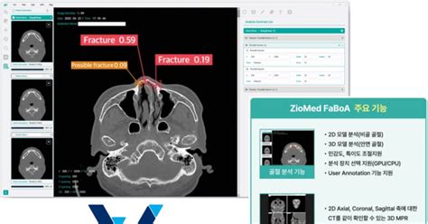 지오비전 의료 영상분석 소프트웨어 Ziomed Faboa 의료기기 제조인증 획득
