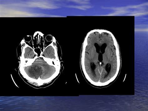 Decompressive Craniectomy And Its Managemnet Ppt
