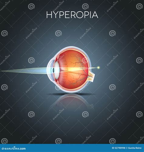 Hyperopia Long Sighted Eye Stock Vector Illustration Of Glass Eyes 52790998