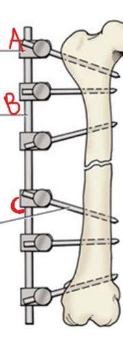 External Skeletal Fixation Flashcards Quizlet