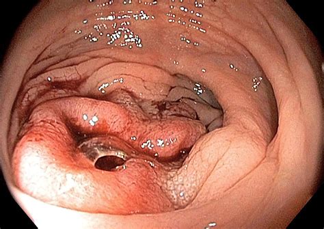 La Muerte Tras Una Colonoscopia Por Perforación Intestinal ¿admite