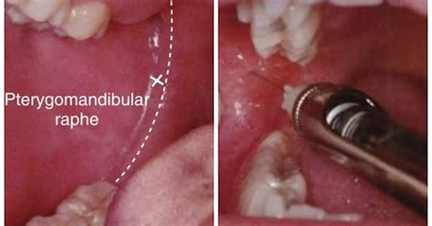 How To Give Inferior Alveolar Nerve Block Ianb Dentistryzone