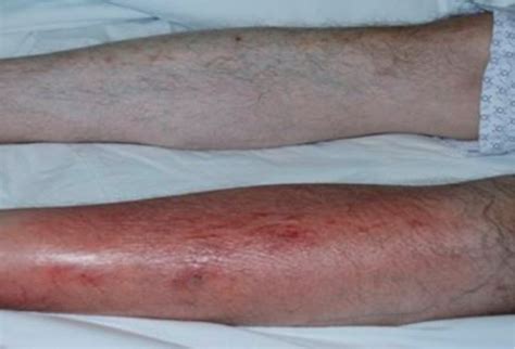 Venous Stasis Dermatitis Cellulitis