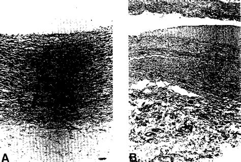 Figure 2 From Hypoplastic Aortic Arch Morphology Pertinent To Growth