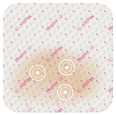 Introducing Mepilex Up An Innovative Foam Dressing Designed For