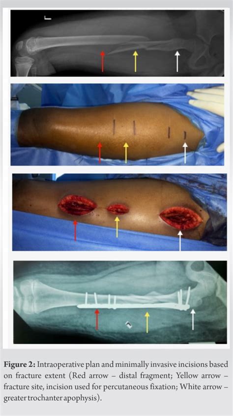 Minimally Invasive Percutaneous Plate Osteosynthesis With Proximal Humerus Locking Plate For