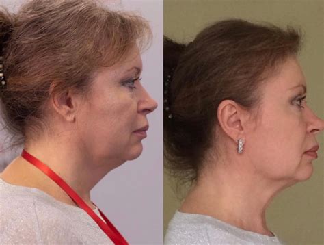 Look 5 10 Years Babeer After Taking My Face Fitness Courses