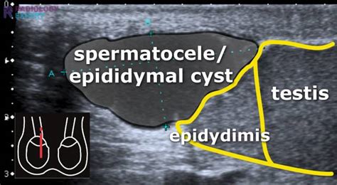 Scrotal Ultrasound