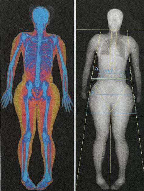 Body Composition Of Bone Muscle And Fat Rpics