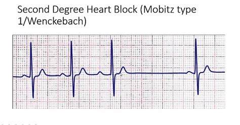 Prepare For Medical Exams Wenckebach Or Type I Second Degree Av Block
