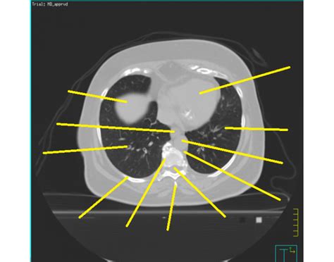 Heart Ct Scan Labeled