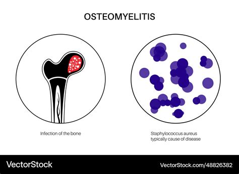 Osteomyelitis Of Hip Royalty Free Vector Image