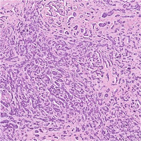 Histopathological Cross Section Of Tongue Tumor Tumor At The Tongue