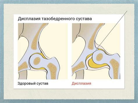 Дисплазия тазобедренного сустава Врожденный вывих бедра презентация онлайн