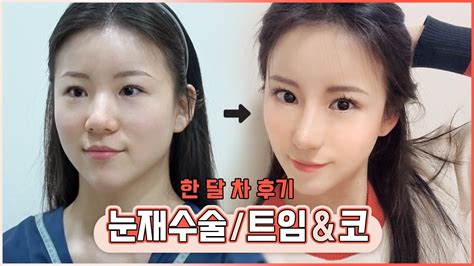 성형브이로그 레전드 풀트임 🤩눈트임성형전후 와 코성형전후 🧐코성형수술 후기 인터뷰 단추구멍 눈에서 왕눈이로 트임수술 눈트임 코성형브이로그 코성형수술