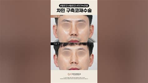 비주함몰 구축코 코뼈돌출 차민에서 4번째 코재수술 1개월 후 모습은 Youtube