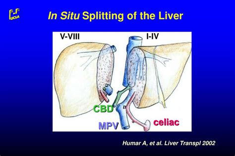 Ppt New Strategies In Split Liver Transplantation Powerpoint