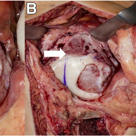 A Severe Type Of Trochlear Dysplasia With Supratrochlear Spur In Left Download Scientific