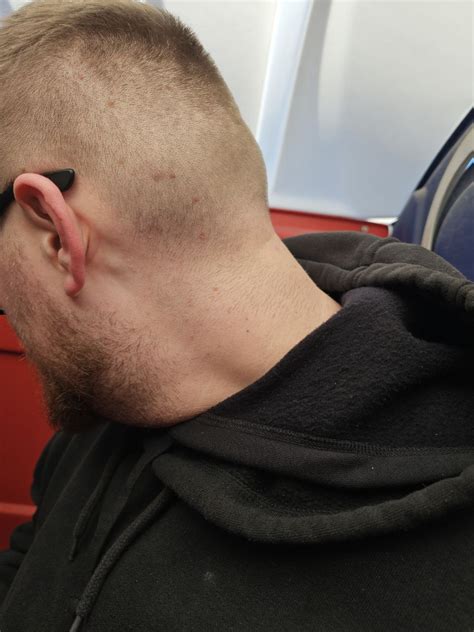 Hard Lump Behind Left Ear Worried You Might Have A Blood Cancer