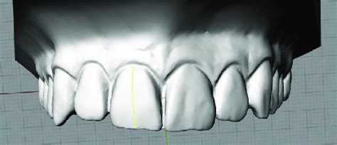 The Facial Axis Of The Clinical Crown Line Is Traced On The Vestibular