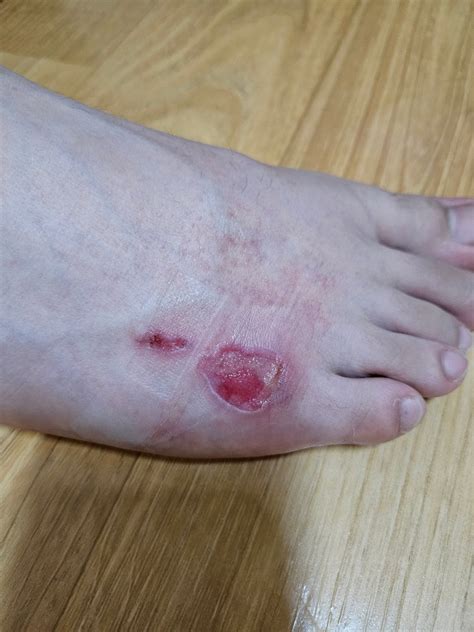 심재성 2도 화상 지식in