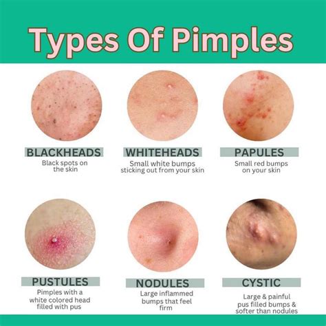 When Can You Pop A Pimple 3 Signs You Can Pop It Natural Skin Guides Acne Treatments And Kits