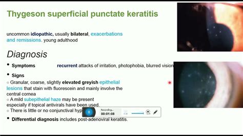 Thygeson Superficial Punctate Keratitis Youtube