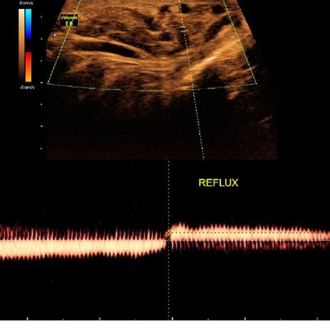 A B Mode Sonogram Shows Dilated Veins Of The Pampiniform Plexus