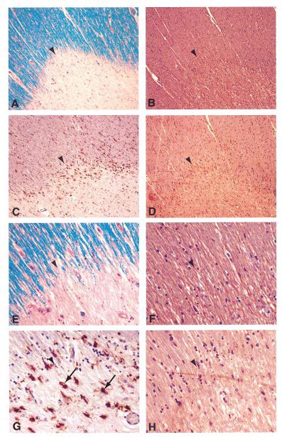 Photomicrographs Of A Demyelinating Lesion In Patient 2 Arrowheads